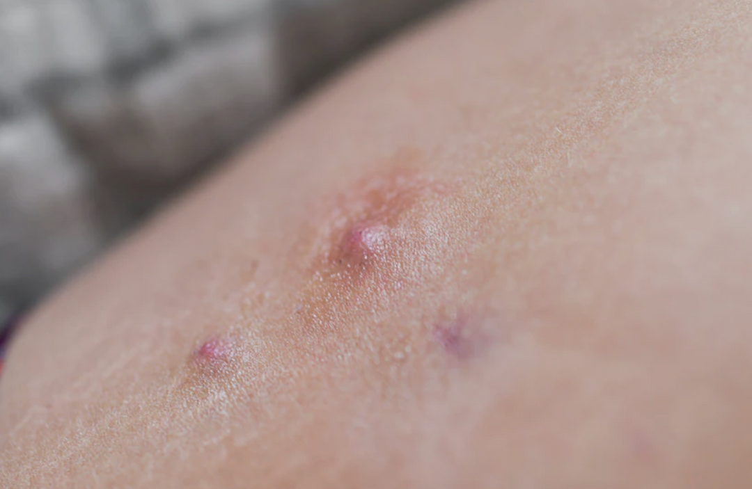 How to Draw a Boil to a Head | 3 Effective Methods – Legend's Creek Farm