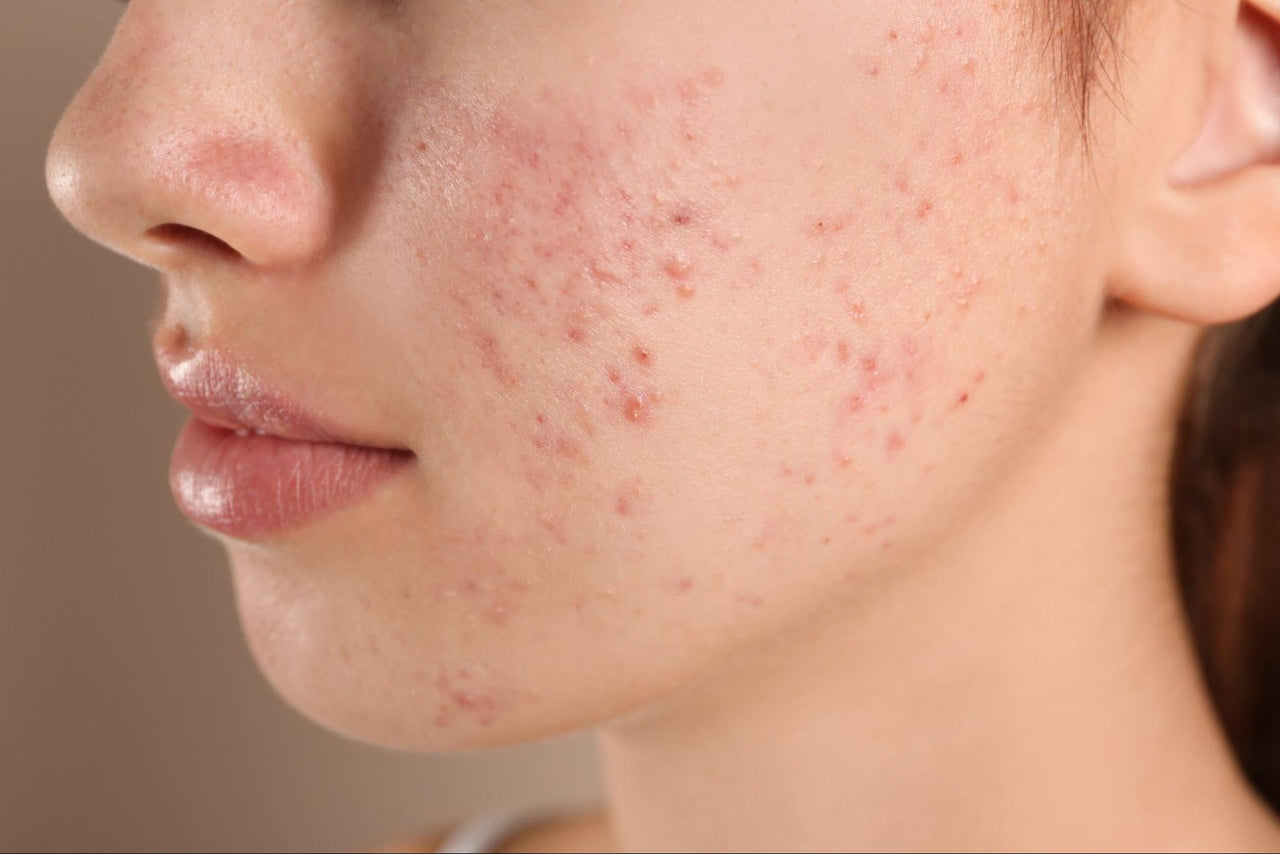 Drawing Salve for Pimples: What Actually Works – Legend's Creek Farm